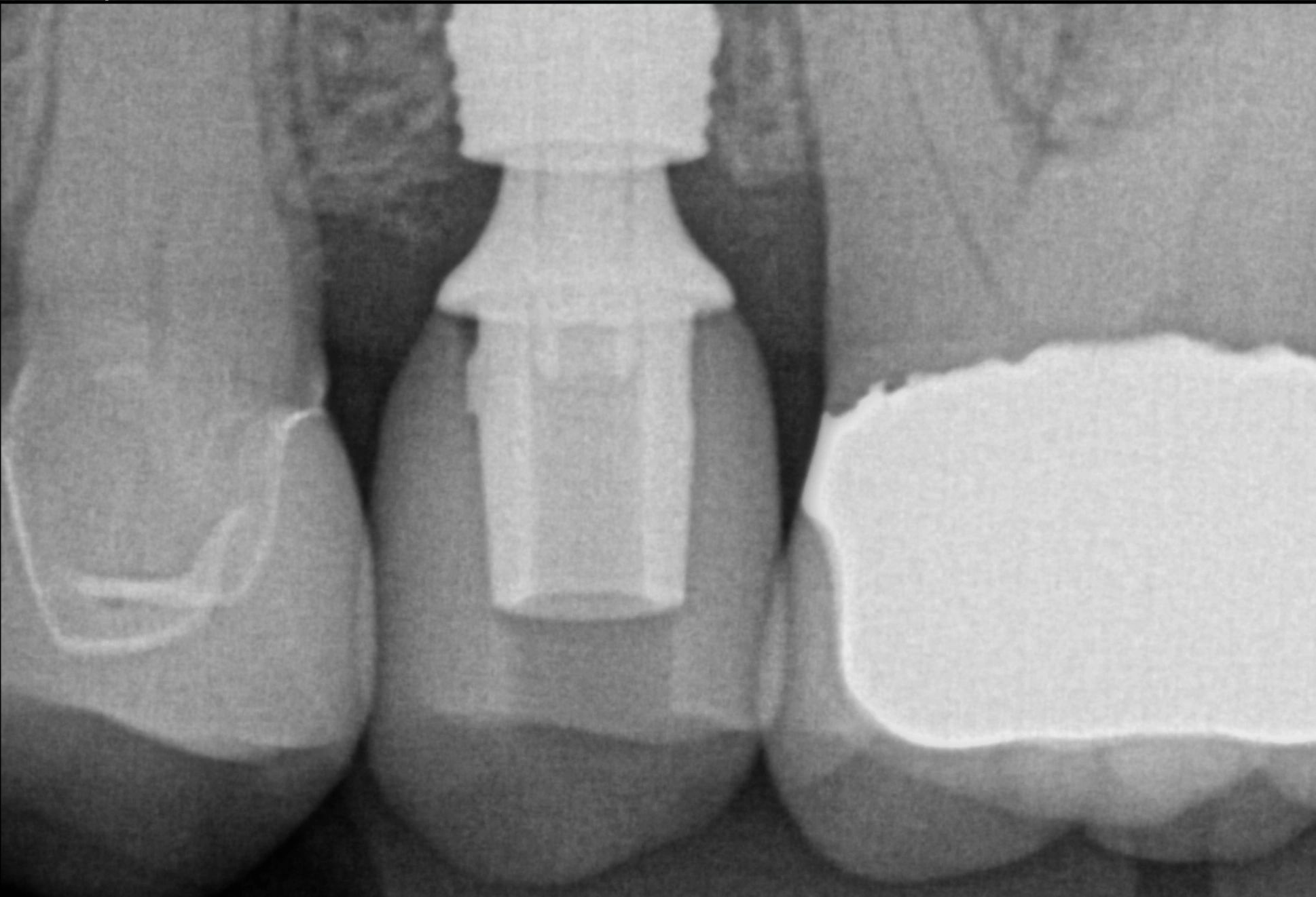 Saving on TiBase CAD/CAM Restorations