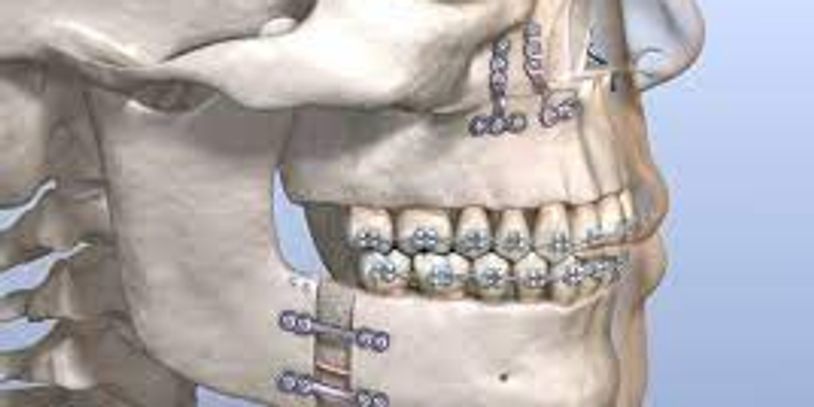 Bimaxillary Osteotomy