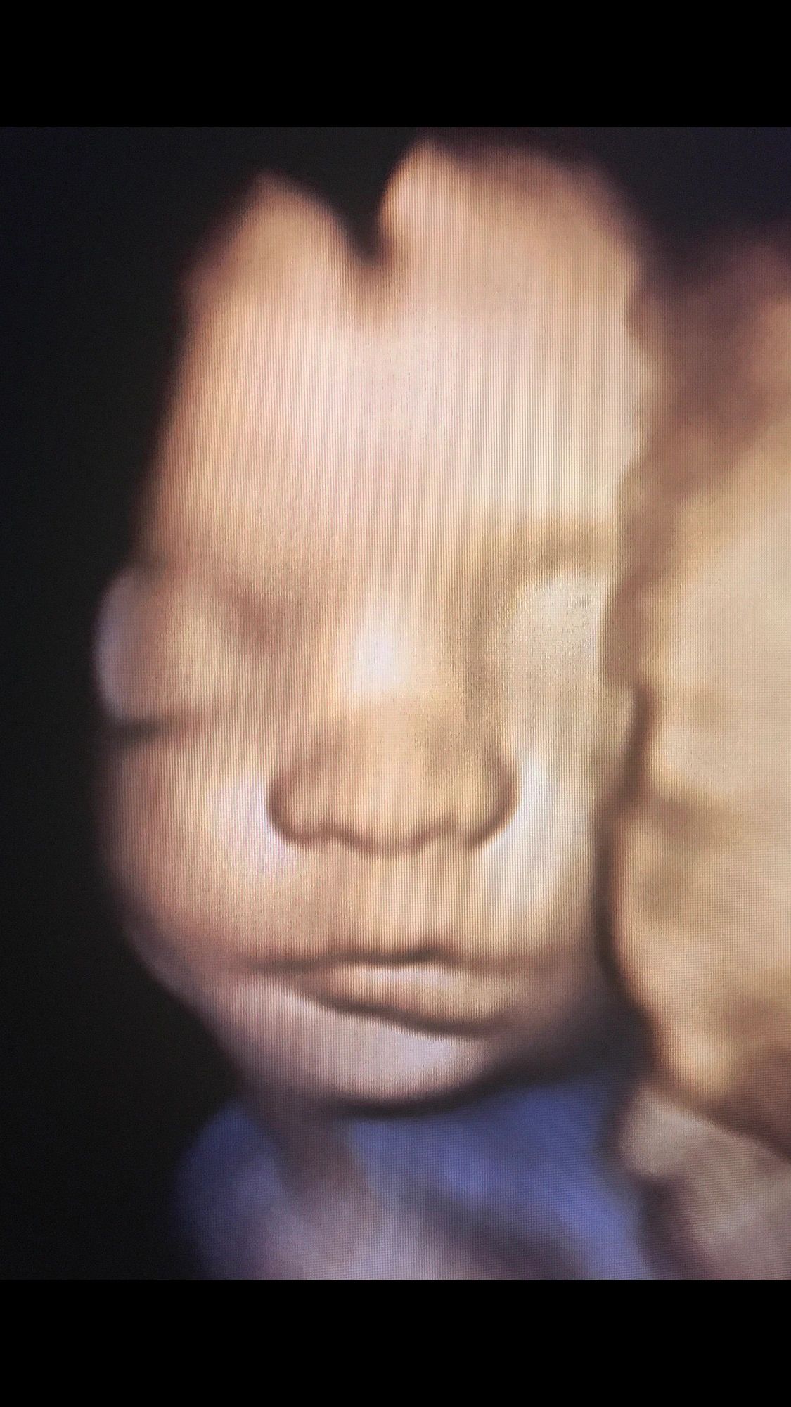 3d 4D Baby Ultrasound Baby Face 4D Ultrasound 3d 4D Baby Ultrasound Baby Face 4D Ultrasound