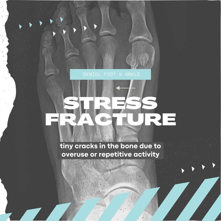 Preventing Bone Stress Injuries