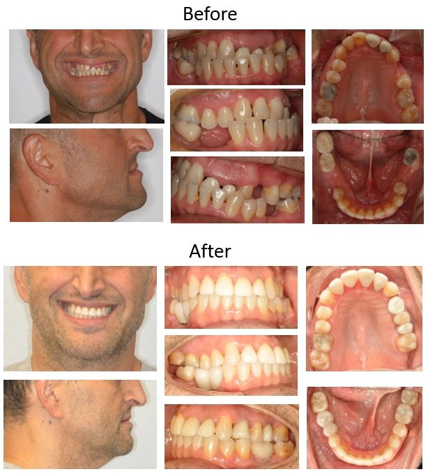 Class Iii Asymmetry Case