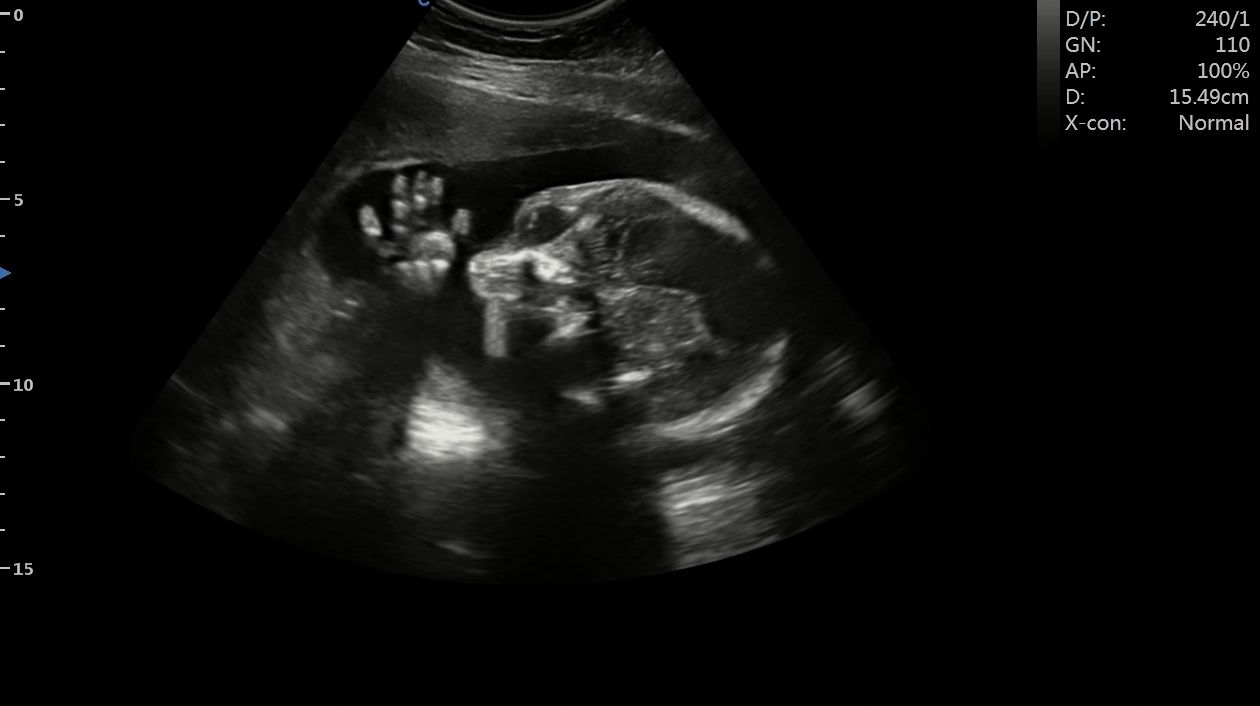 25 Weeks Pregnant 3d Ultrasound