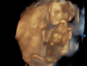 20-week-3d-ultrasound