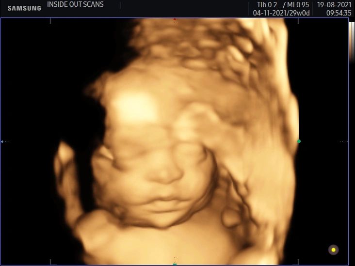 Obstetric and 4D/HD Scan