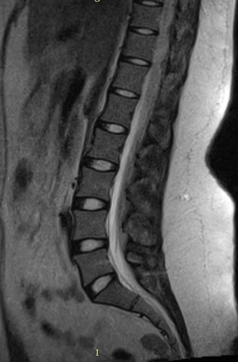Spinal Metrix