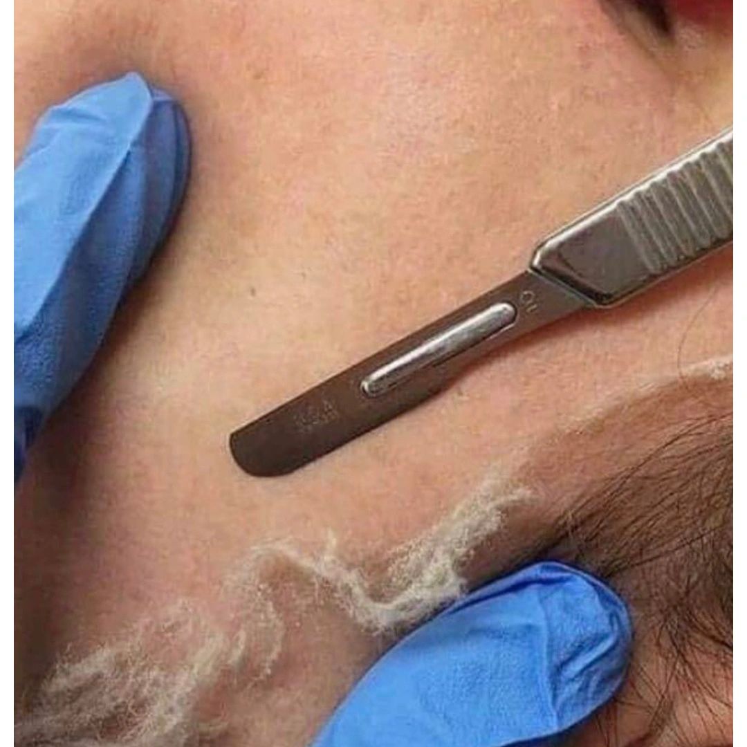 Dermaplaning vs. Shaving: Why You Shouldn’t Dermaplane at Home