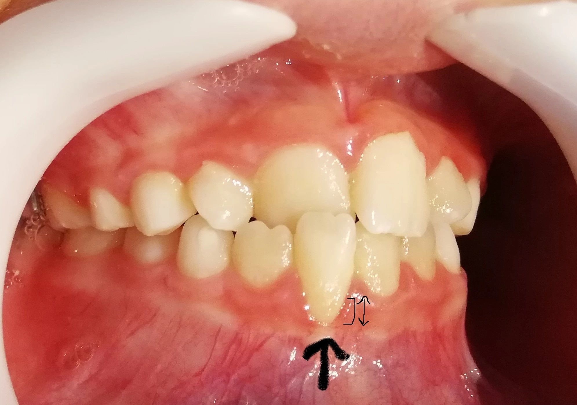 Unilateral Cross bite or reversed Occlusion