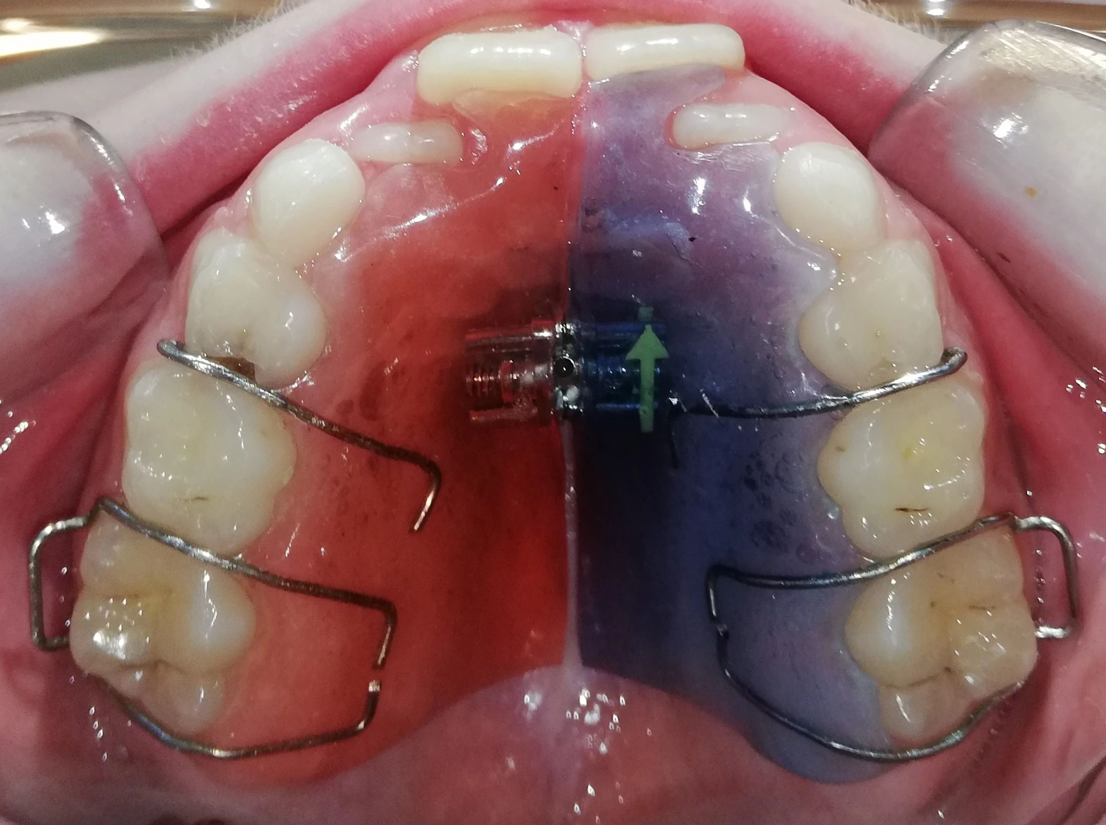 Delayed tooth eruption and Narrow Maxillary (upper) Arch