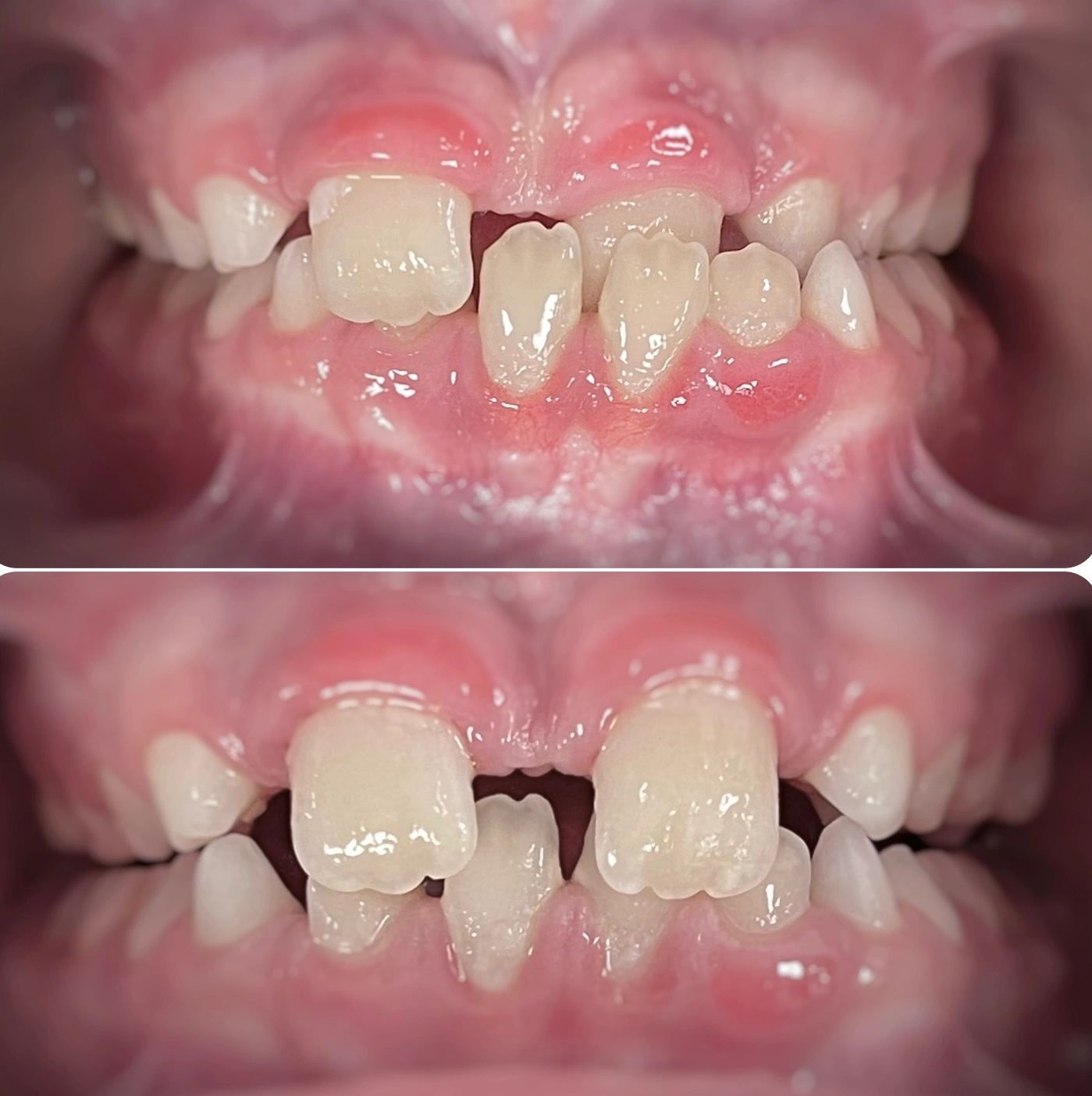 Anterior Cross bite in kids