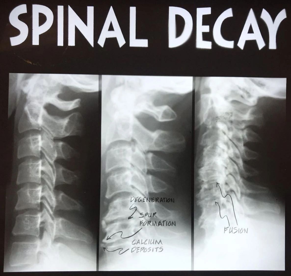 Degeneration of Spine