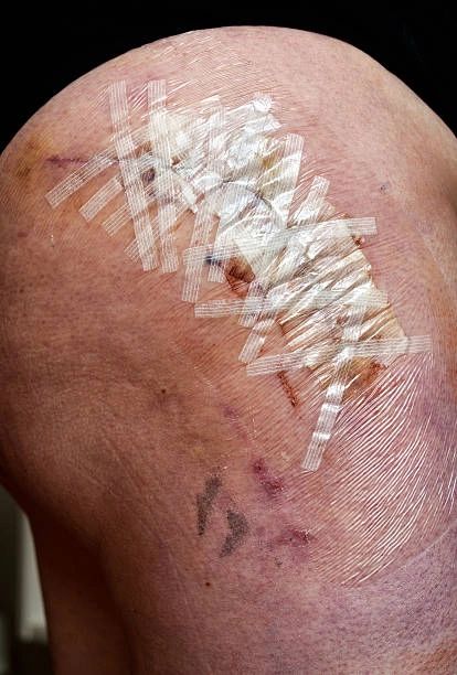 Don't Let Lymphedema Leave You Limping: The Power of Post-Surgery