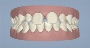 Will space between front teeth close itself?