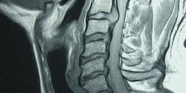 Cervical Facet Blocks