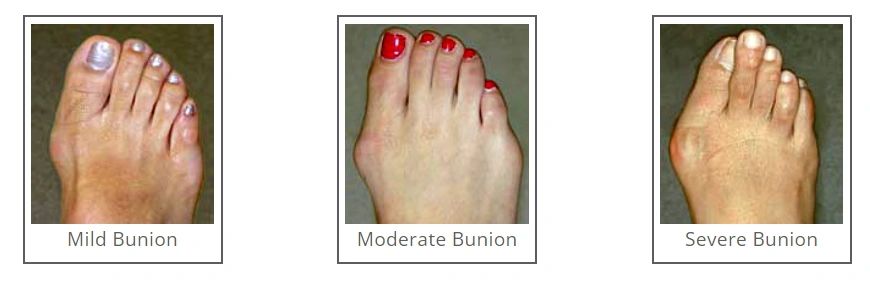 Bunions: A Common Foot Condition