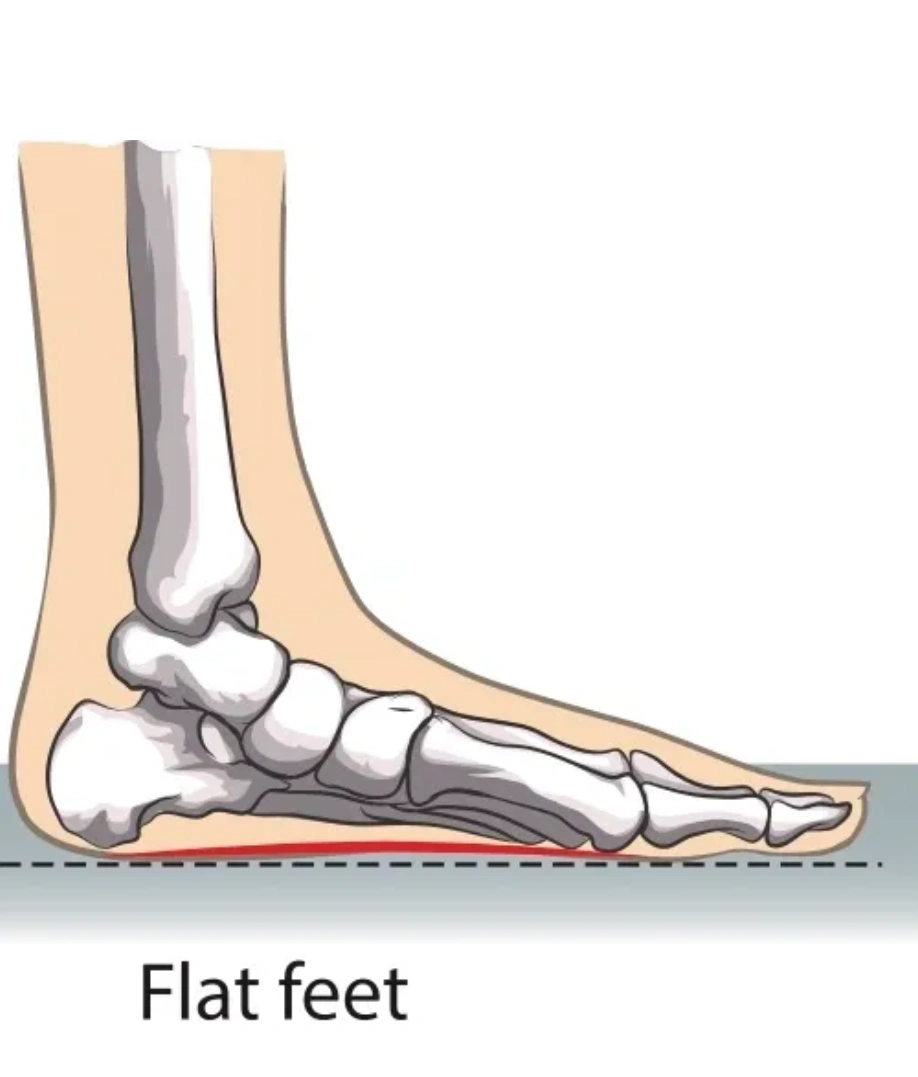 Help Do I Have Flat Feet