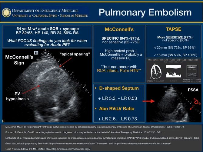 Pulmonary Embolism Rcem