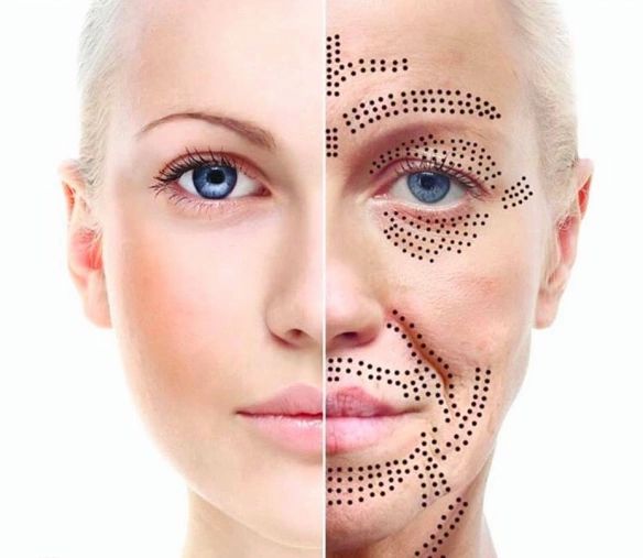 Fibroblast Collagen Lift