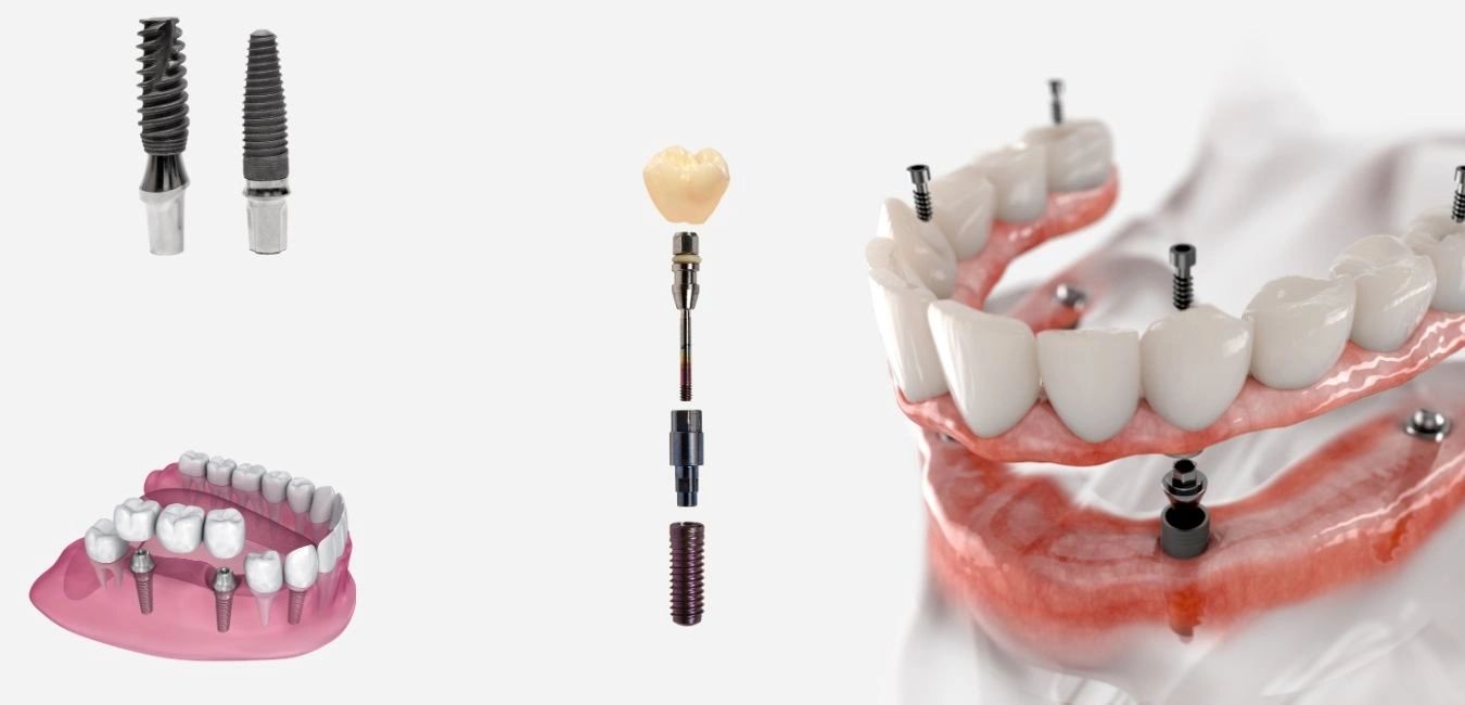 WHAT ARE DIFFERENT TYPES OF DENTAL IMPLANTS
