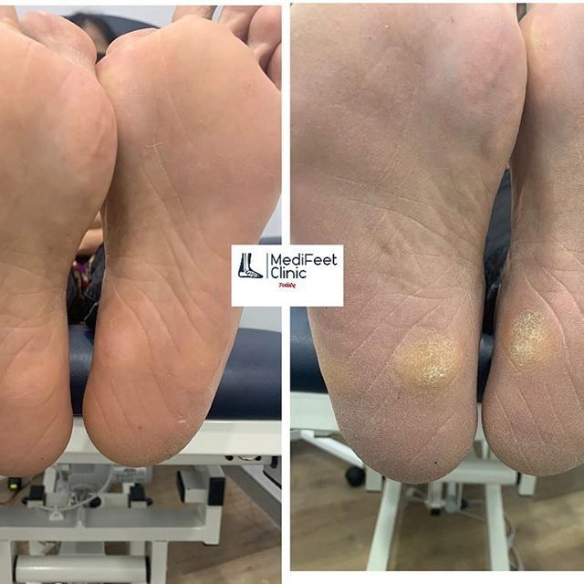 Hyperkeratosis Feet