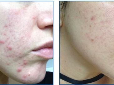 IPL Acne Treatment | Lila's Mini Spa