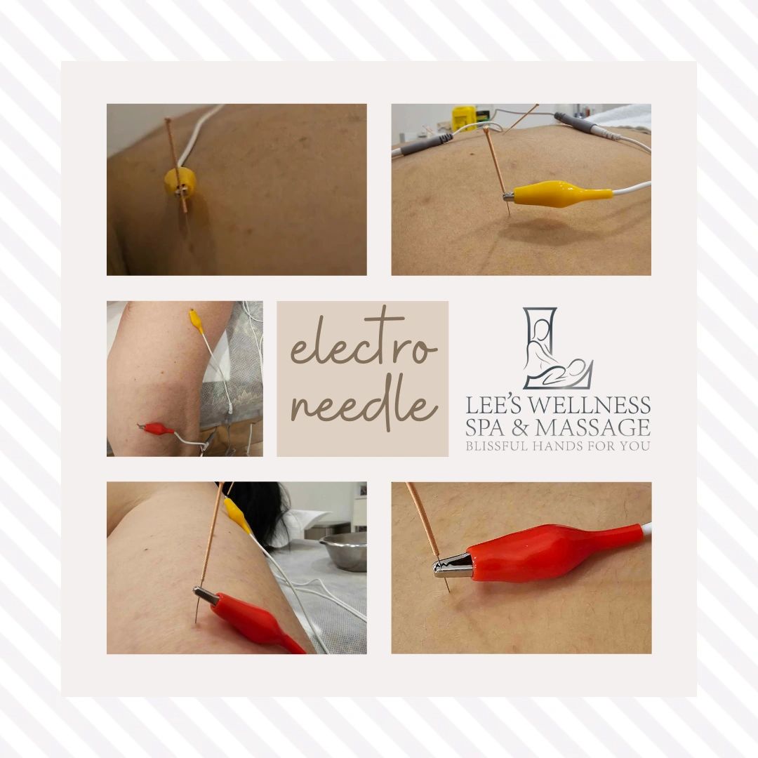 Electro-Needling: The Future of Pain Relief and Muscle Recovery