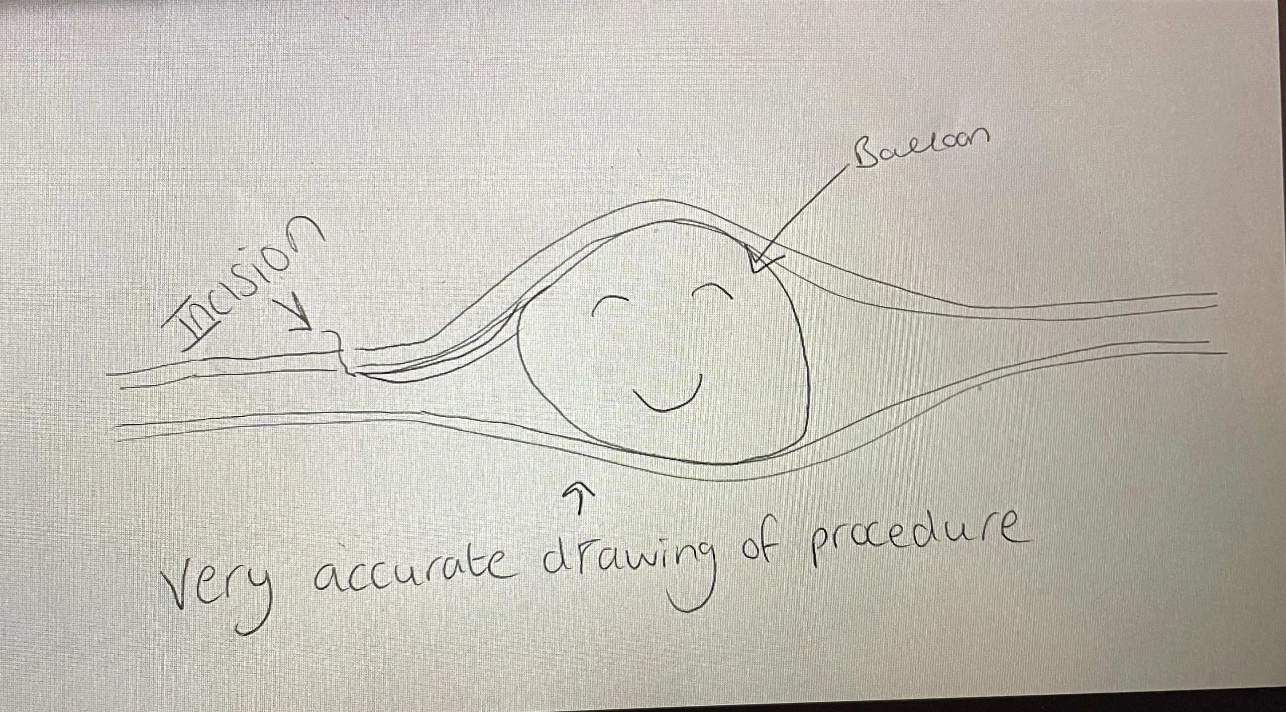 The World's Smallest Balloons