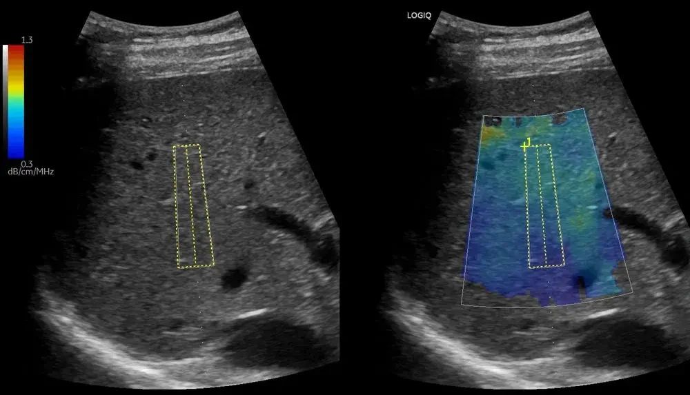 Cómo se diagnostica el Hígado Graso