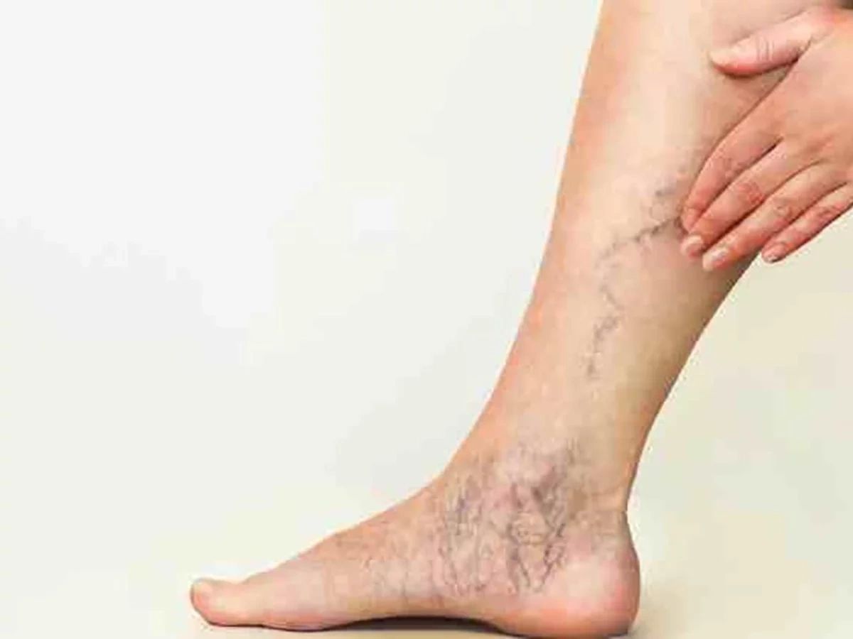 Tromboflebitis Del Pie La Tromboflebitis Y Fisioterapia | RPP Noticias