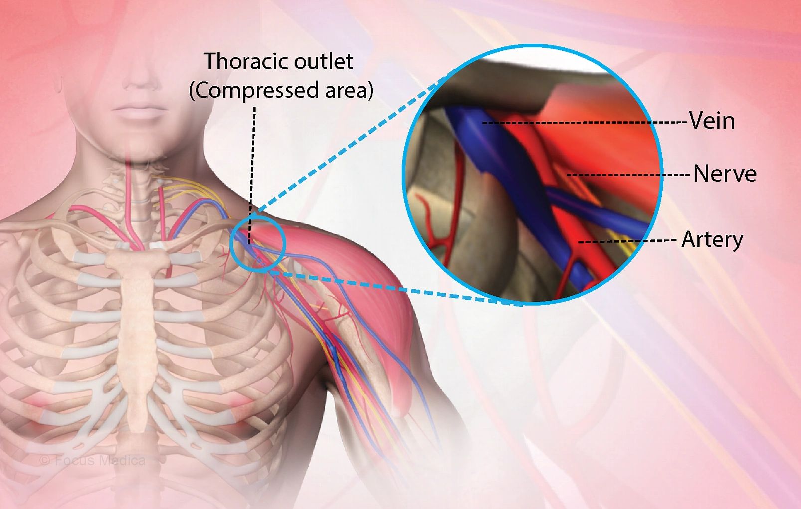Thoracic Outlet Syndrome (TOS) Causes, Treatment & Home Exercises