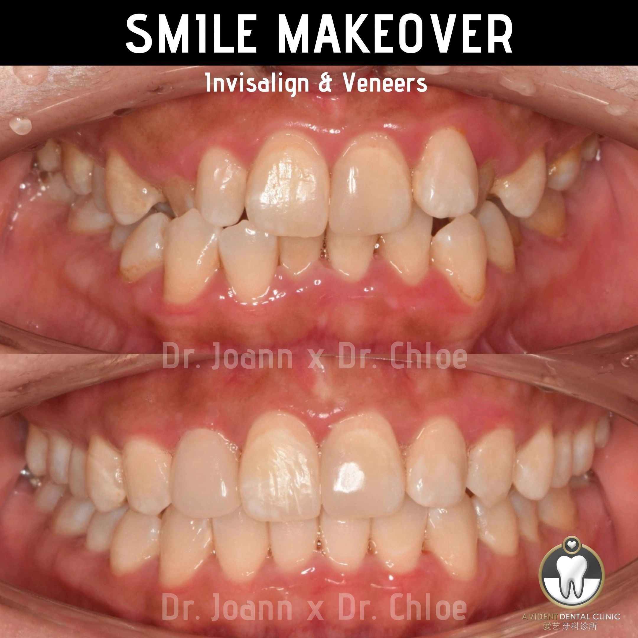 What is Smile Makeover Treatment