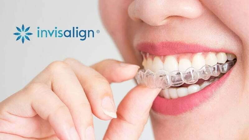 How Invisalign Can Improve Malocclusion and Its Benefits
