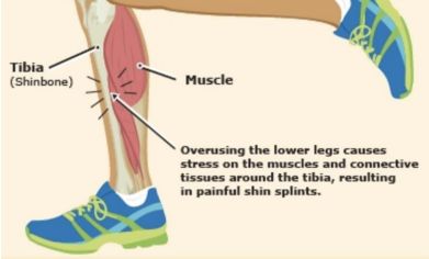 Everything You Need to Know About Shin Splints