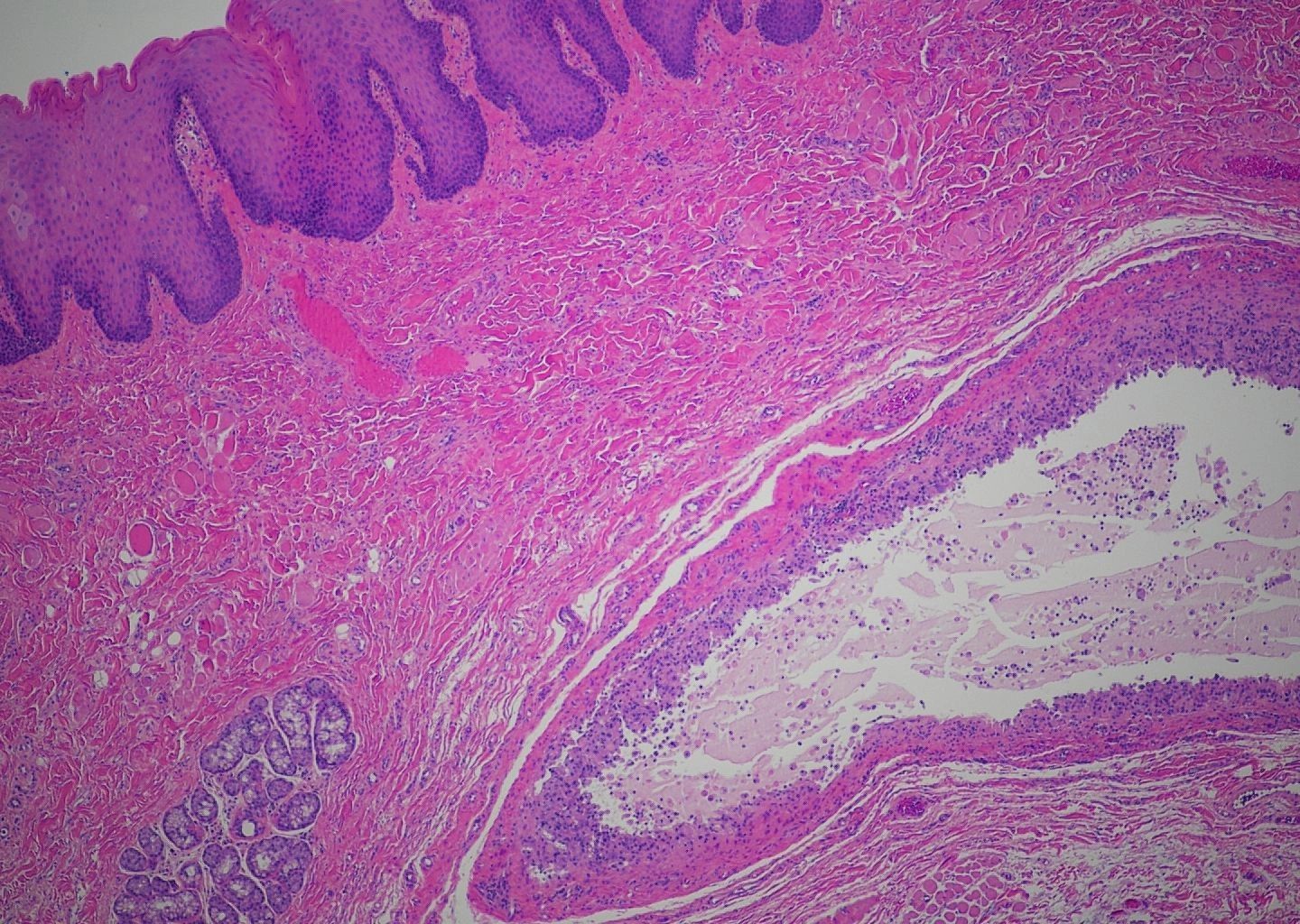 Ranula Histology