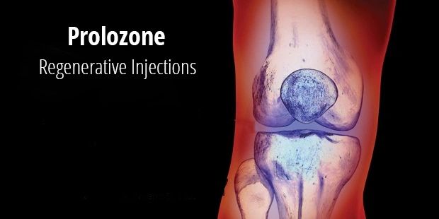 Prolozone Injection
