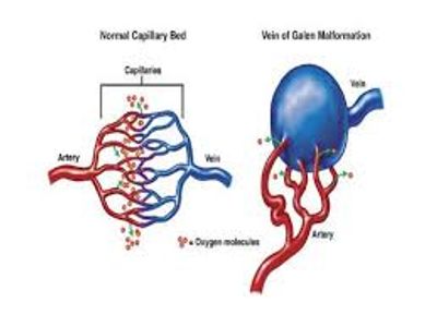 Vein of Galen Malformation - Faq, Information, Questions to Ask | Vein ...