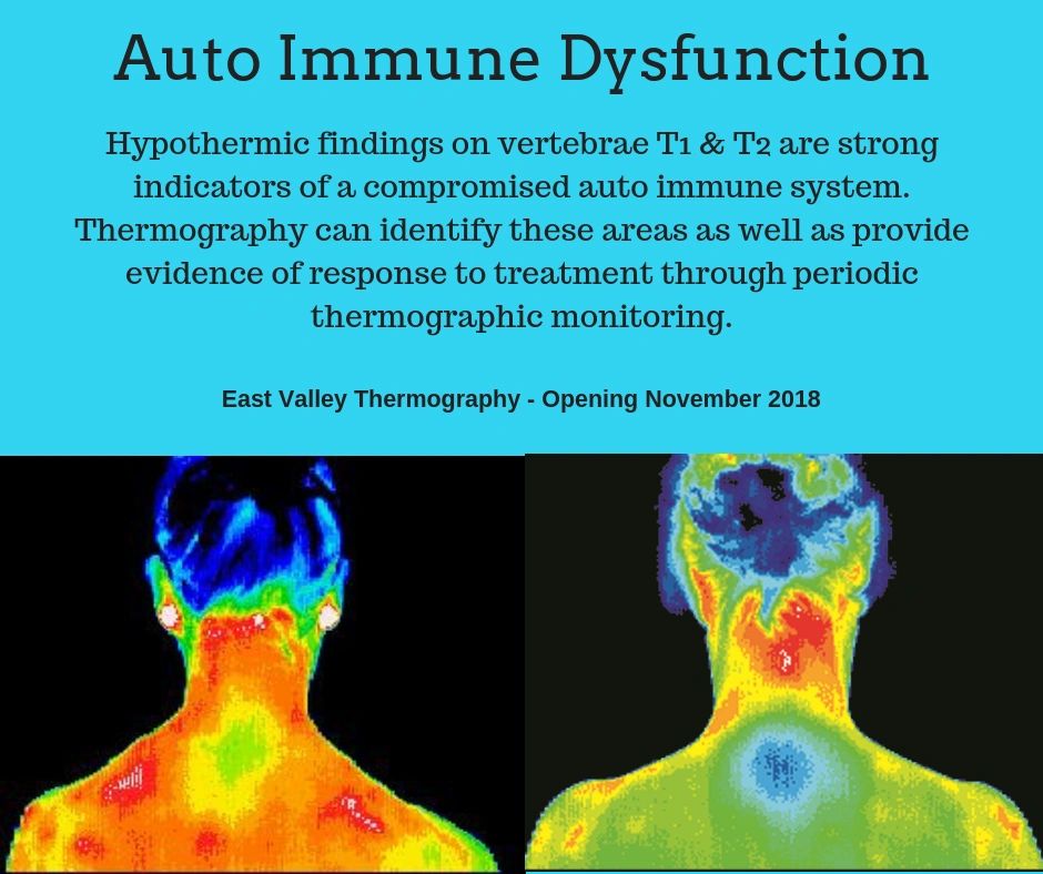 Autoimmune Dysfunction: