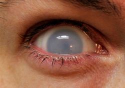 Cataract