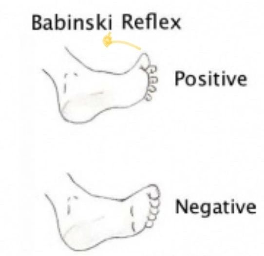 Babinski Reflex