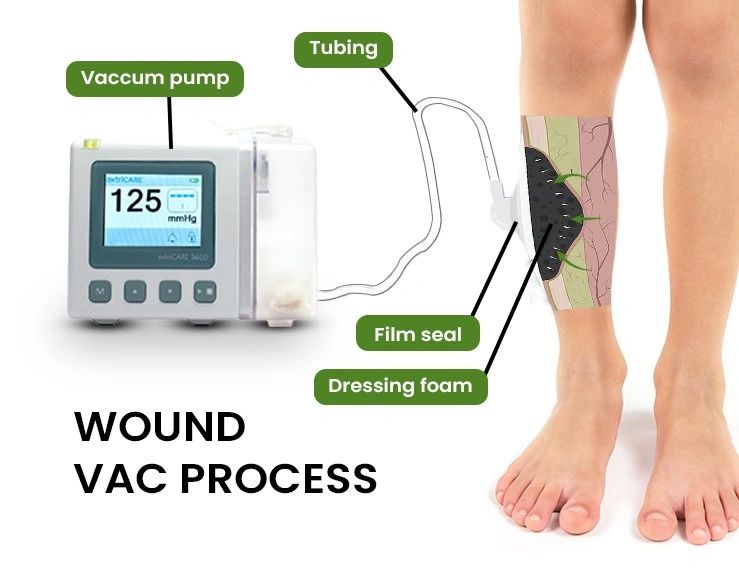 What is a Wound Vac?