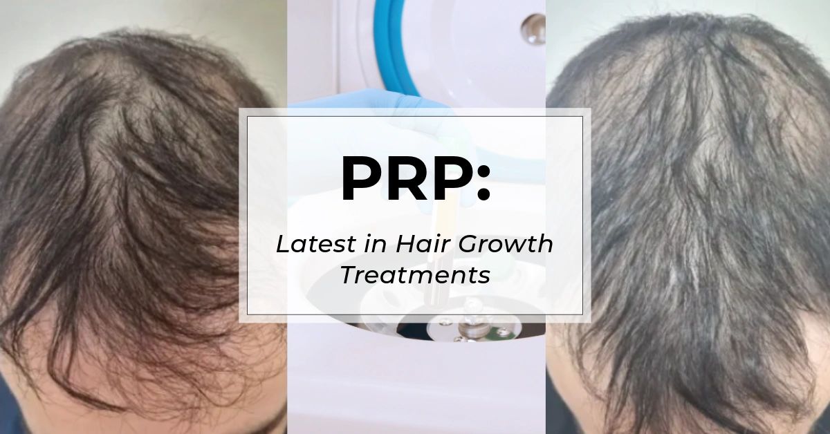 What is PRP (Platelet-Rich Plasma) and Why Should You Get It?