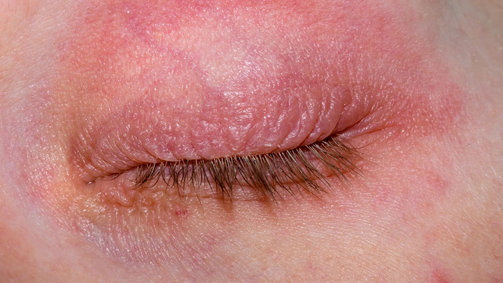 Understanding Eyelid Dermatitis: Causes, Symptoms, and Treatments