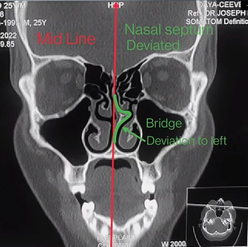 Septoplasty: Understanding the Procedure, Indications, and Care