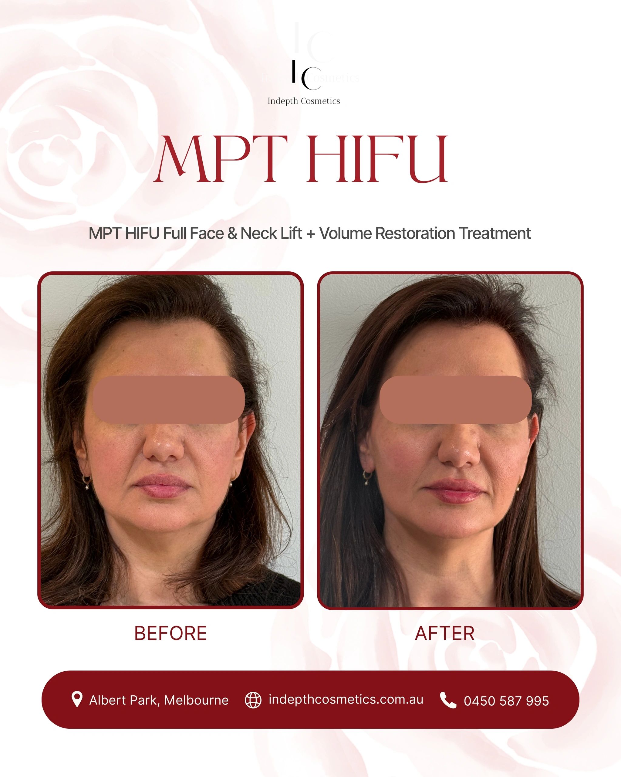 MPT HIFU: The Next Generation Non-Surgical Facelift in Melbourne