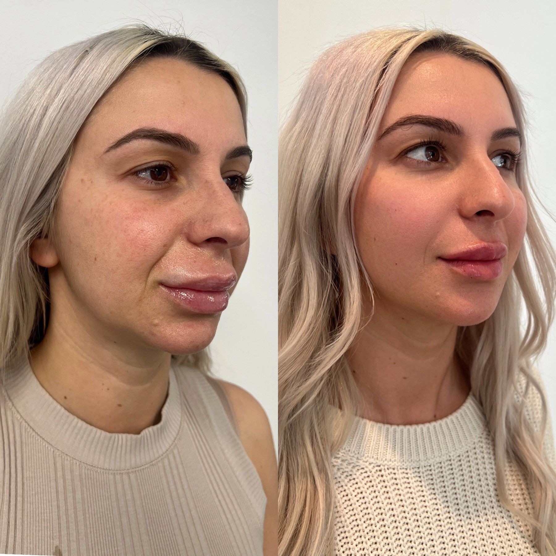 The Complete Guide to Lip Filler Dissolving and Refilling