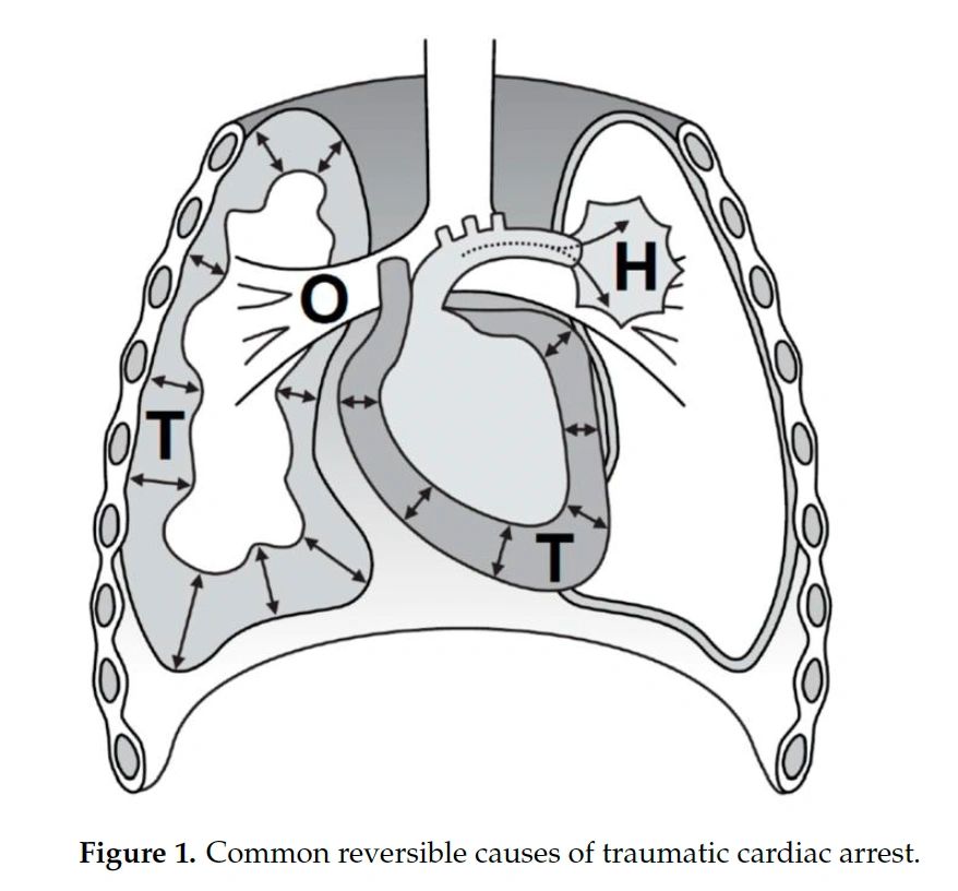 Traumatic Cardiac Arrest—A Narrative Review