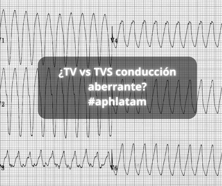 TV vs TSV con conducción aberrante
