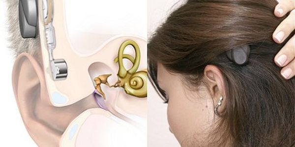 Cochlear Implants | hearingsv.com