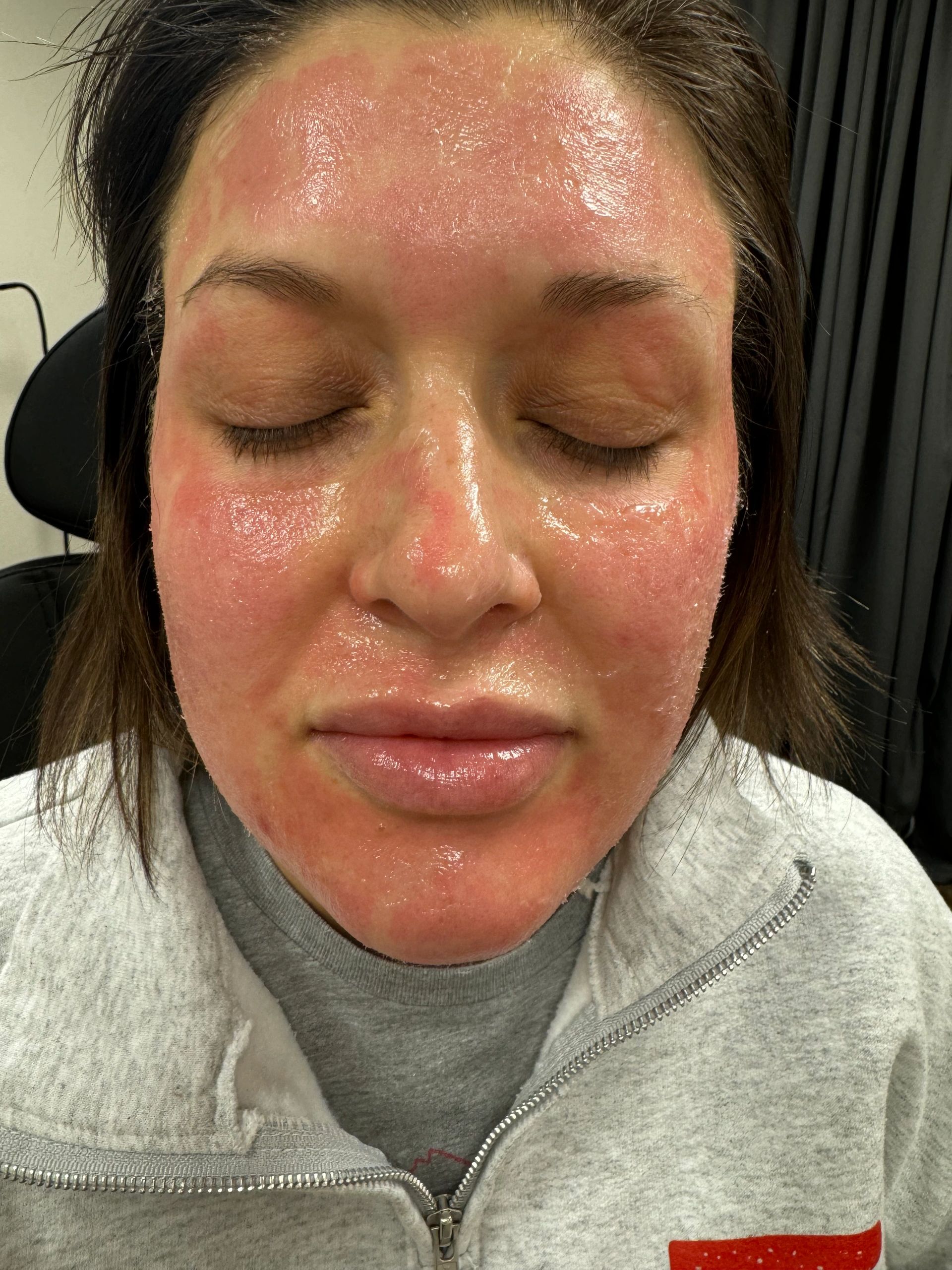 Rise Up Resurfacing treatment!