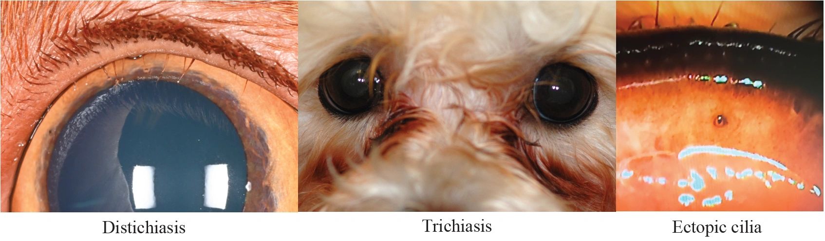 Abnormal Eyelashes: Distichia, Trichiasis, & Ectopic Cilia