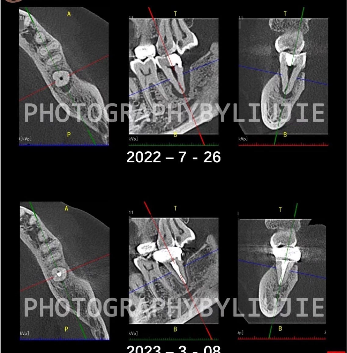 Patented Root Canal Filler and Files - C-Root Dental